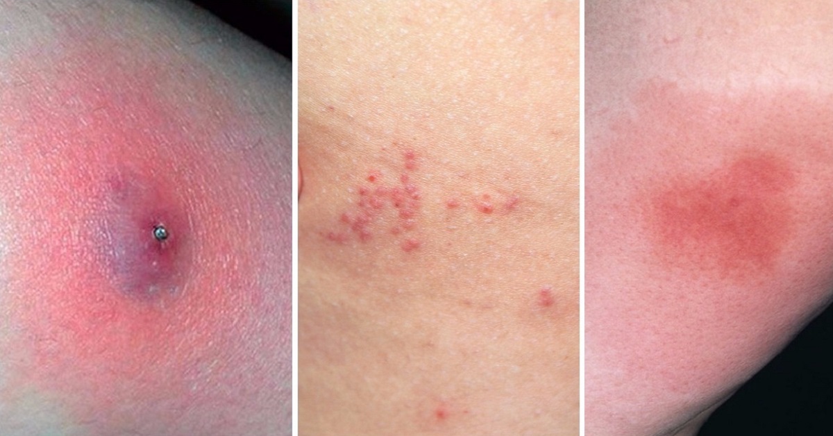 Reacción a una picadura de insecto